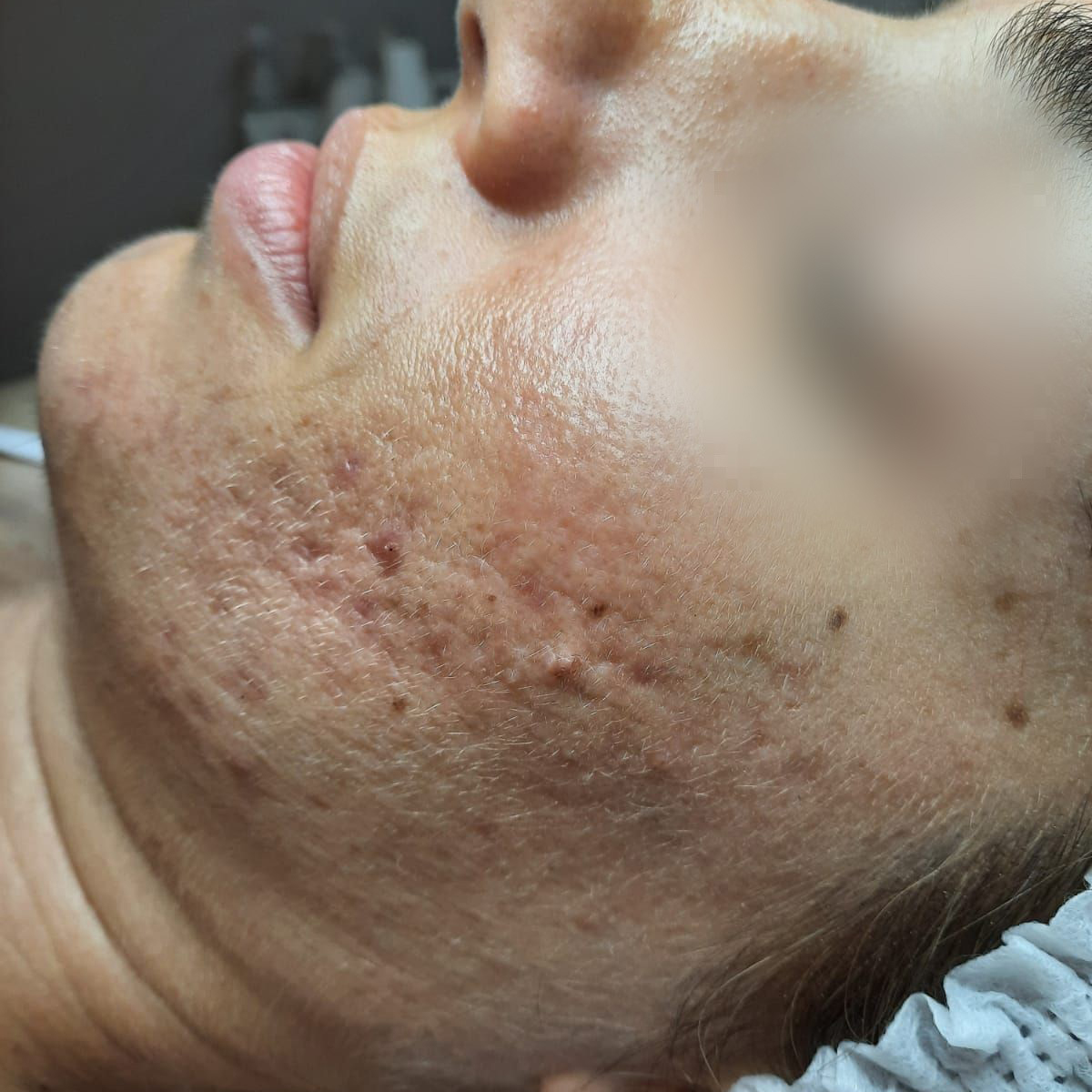 Dr. Platon Kaltplasmagerät » amaderm